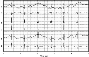Decoding ECG Artifacts for Clarity in Cardiac Monitoring