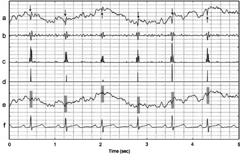Decoding ECG Artifacts for Clarity in Cardiac Monitoring