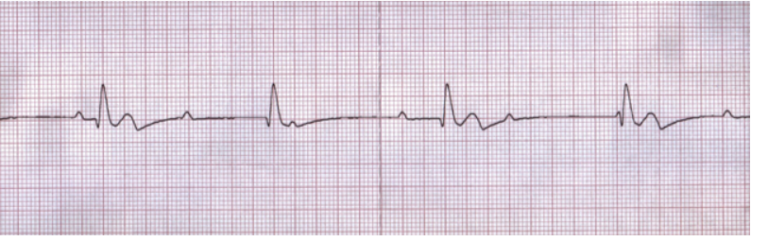 Understand how to identify Pulseless electrical activity