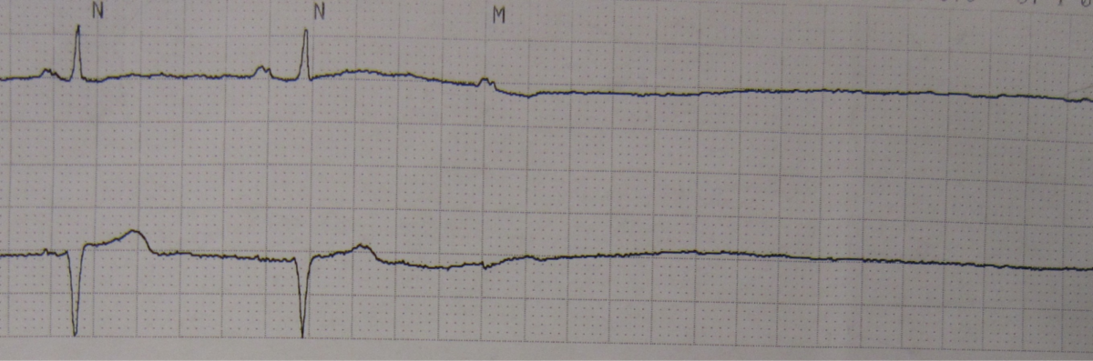 Understand how to identify Pulseless electrical activity