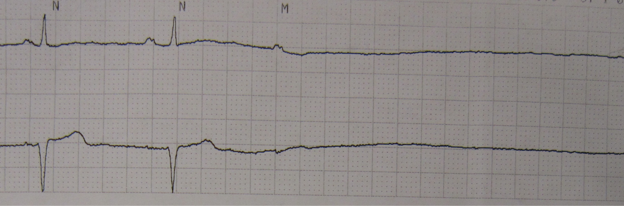 Understand how to identify Pulseless electrical activity