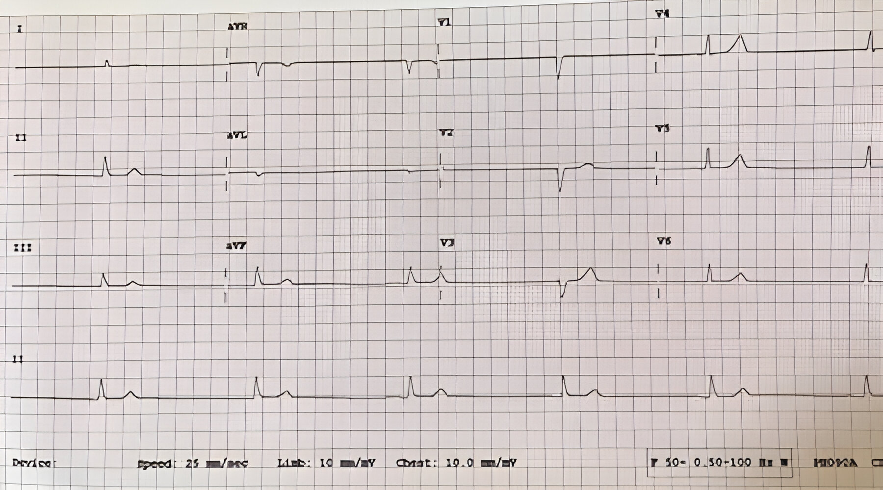 Sinus Bradycardia: Causes, Symptoms & Treatment