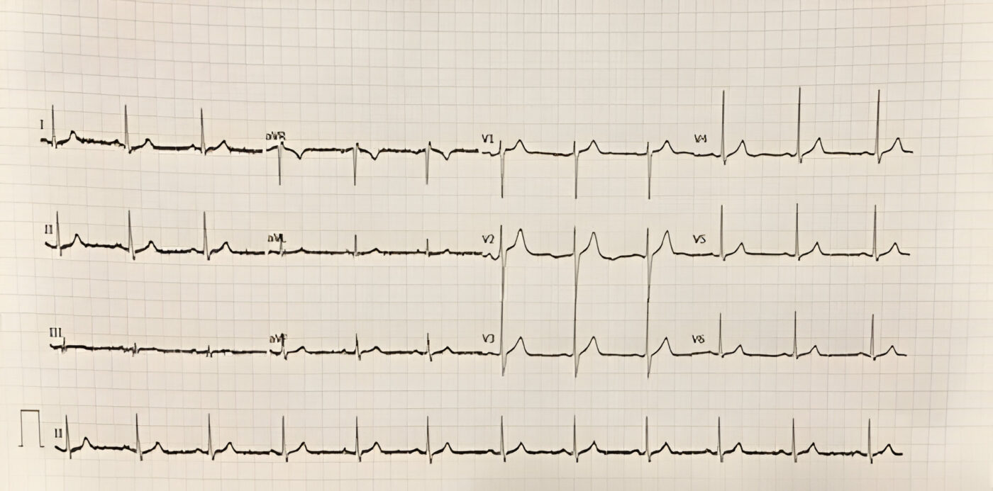 Understanding VF and Pulseless VT: Symptoms, Causes, Treatment