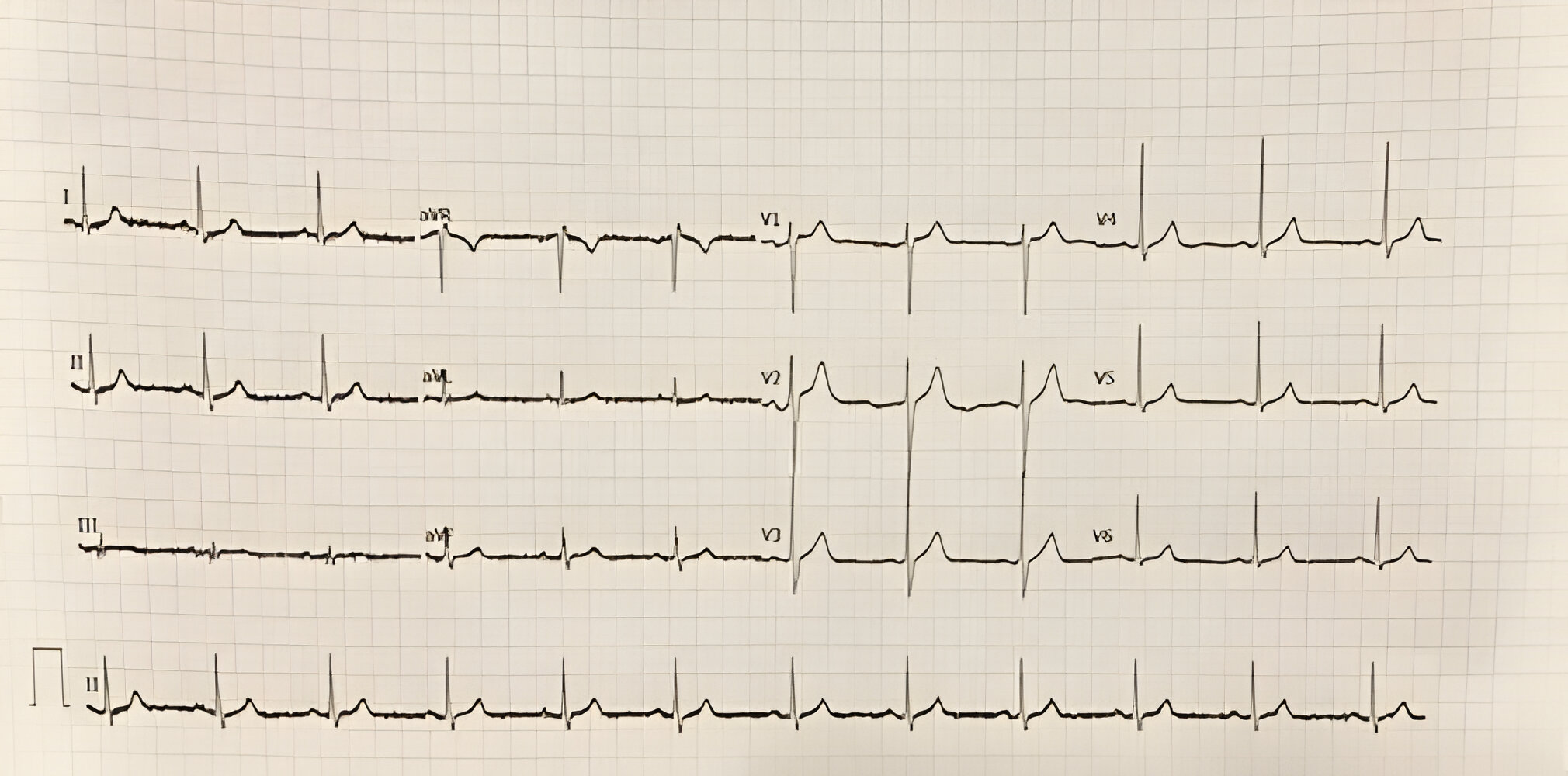 Understanding VF and Pulseless VT: Symptoms, Causes, Treatment