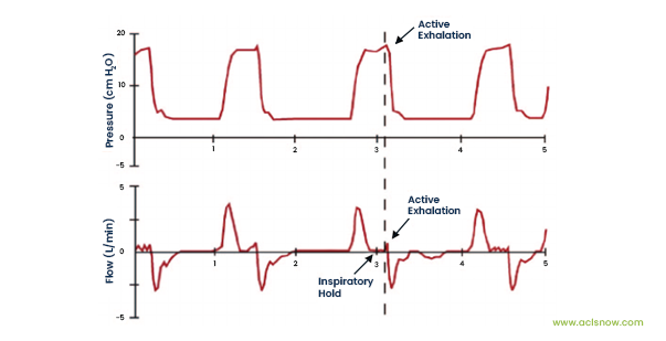 Understanding the Risks: The Effect of Excessive Ventilation in CPR