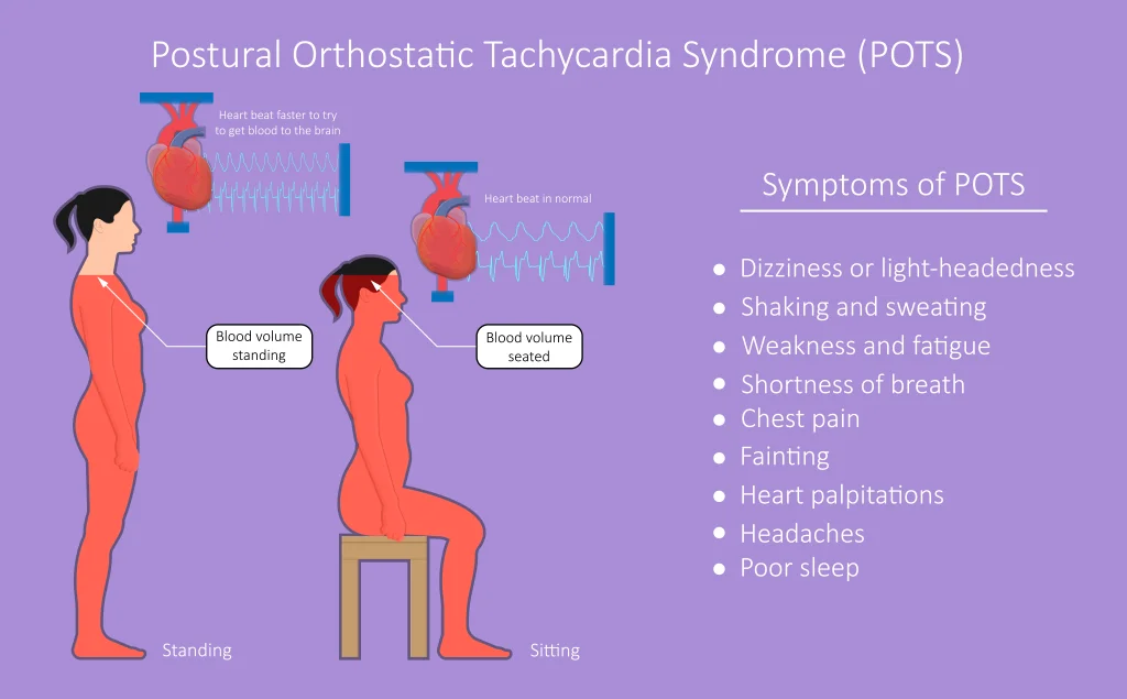 Types of Postural Orthostatic Tachycardia Syndrome (POTS)