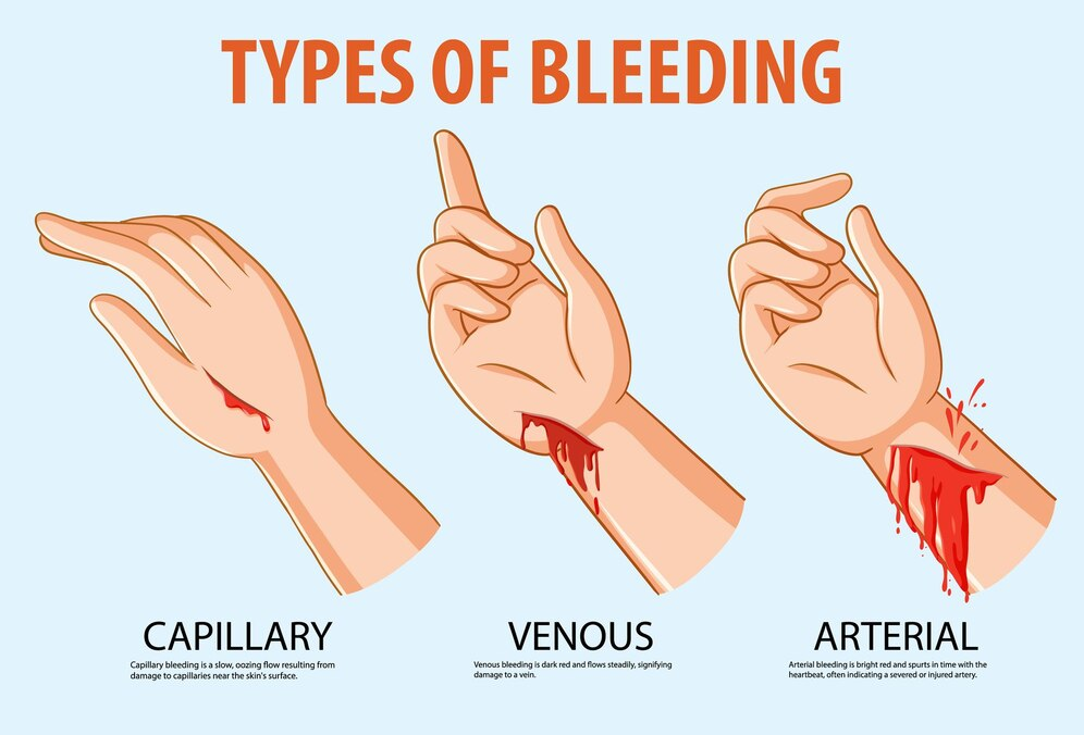 Recognising The Types Of Bleeding A First Aid Guide Recognising The Types Of Bleeding A First Aid Guide