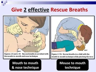 Explore the Indication for mouth-to-mouth rescue breaths