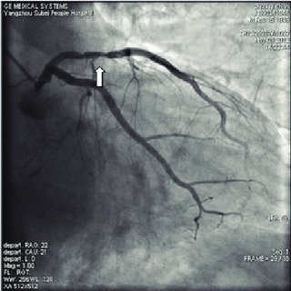 An Illustrative Guide on Heart Blockage with Pictures